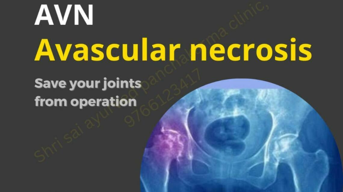 Avascular Necrosis (Avn) Complete Cure Without Operation