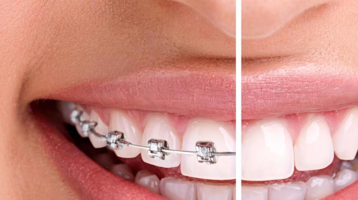 Braces , Trend and Care For