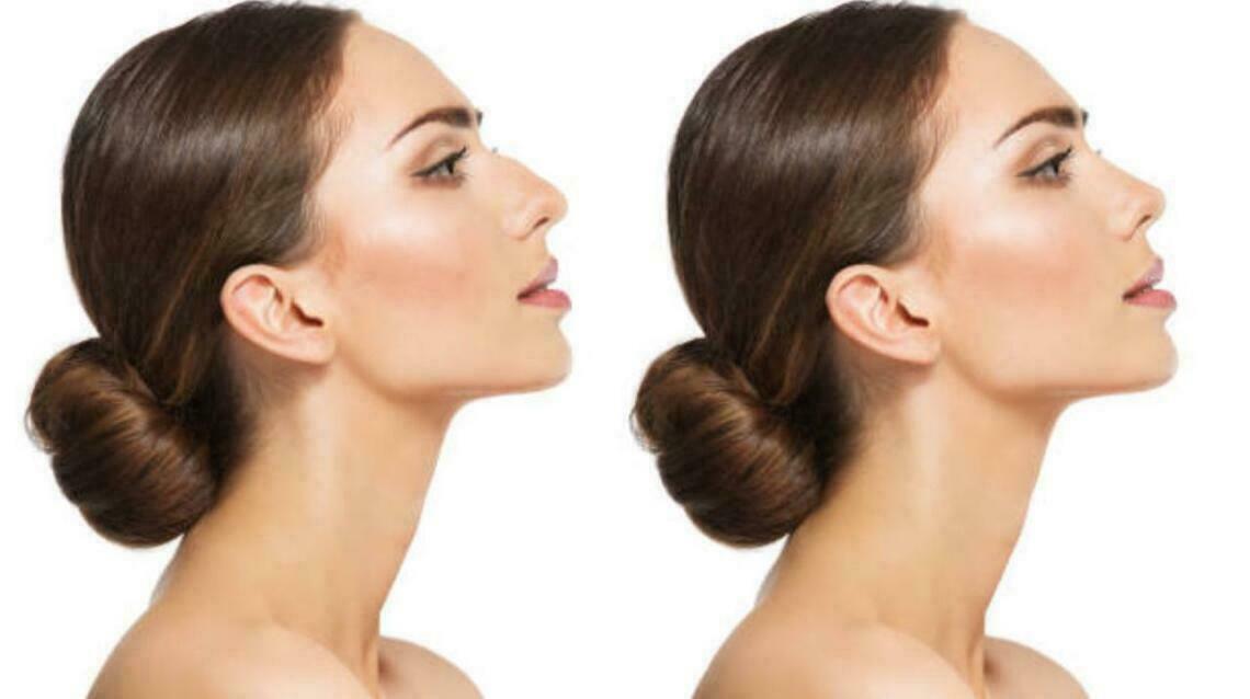 Is Rhinoplasty Painful? Understanding the Procedure & Recovery