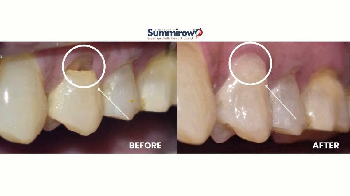 Restoring Comfort: Class v Composite Restoration for Cervical Abrasion ...