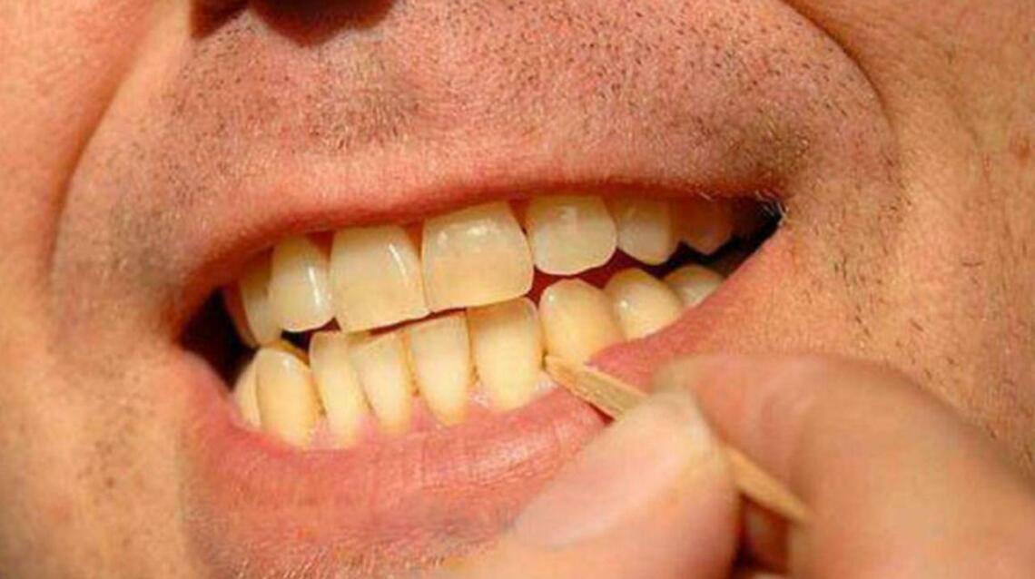 Is Food Stuck in Your Gums and Between Teeth