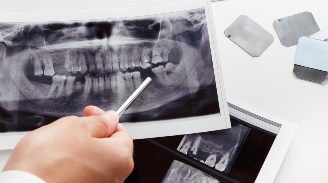 Benefits of Dental Rvg (Radiovisiography)