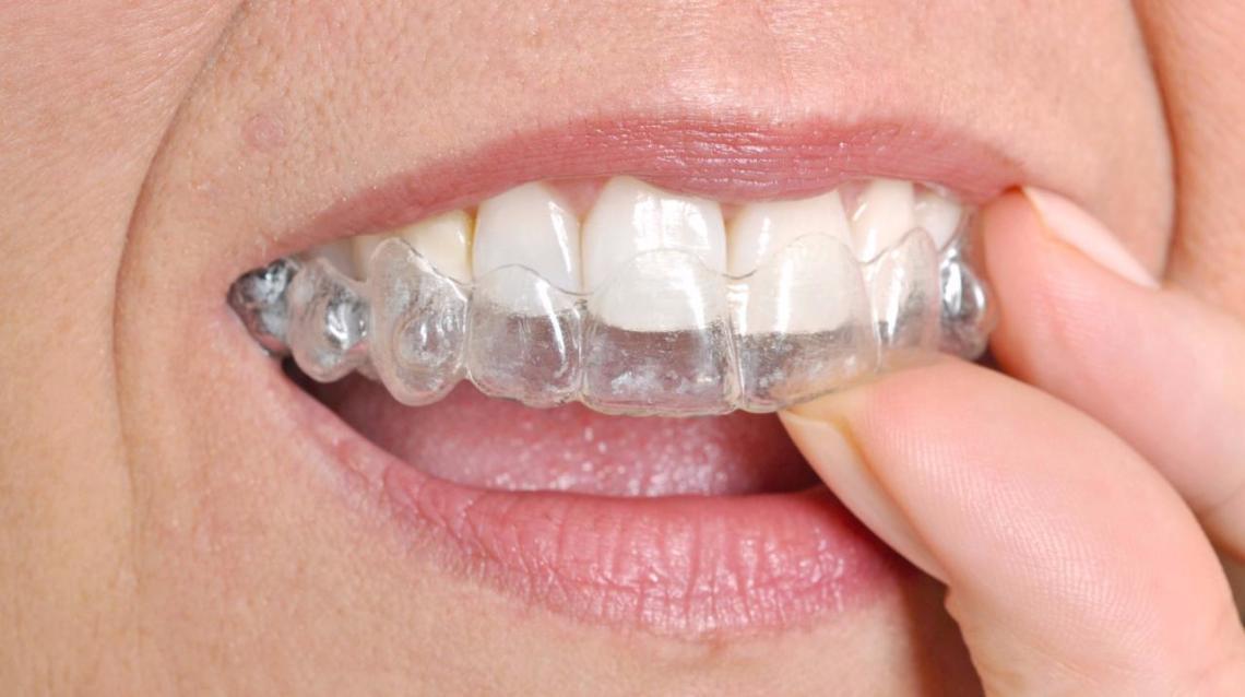 Clear Aligners