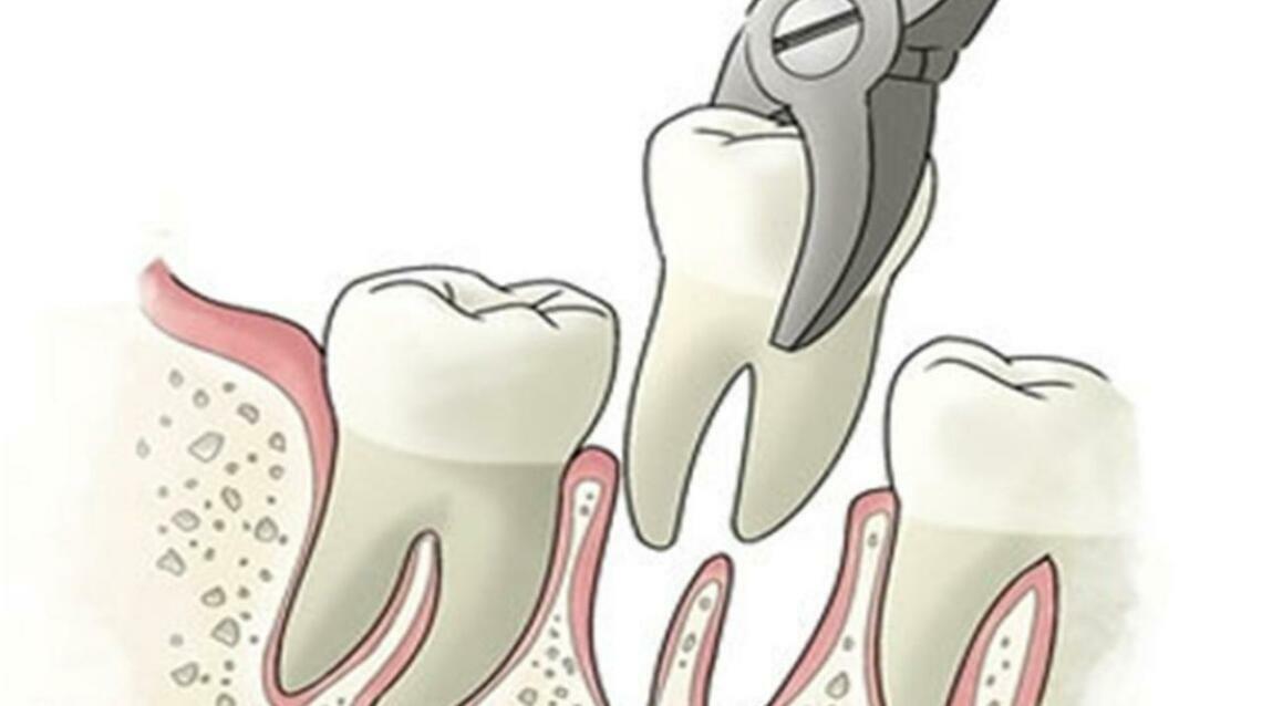 Wisdom Teeth Extraction (3rd Molar Extraction)