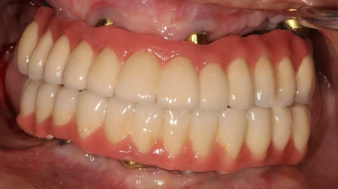 When & Why to Consider Paulo Malo's Prosthesis