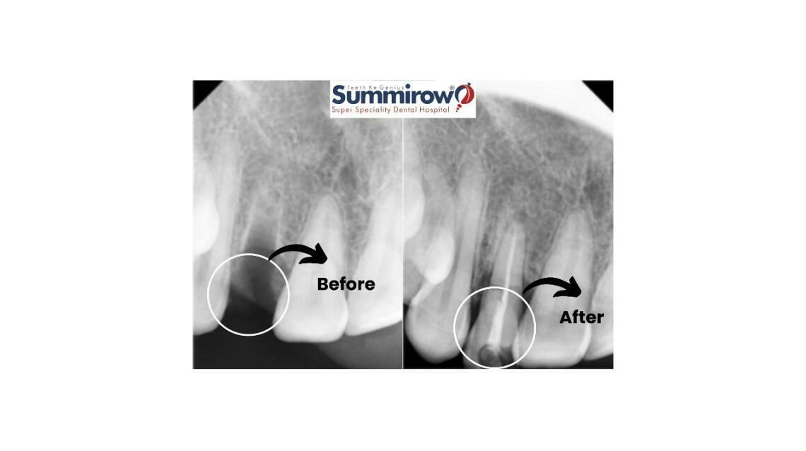 Successful Management of Horizontal Root Fracture With Immediate ...