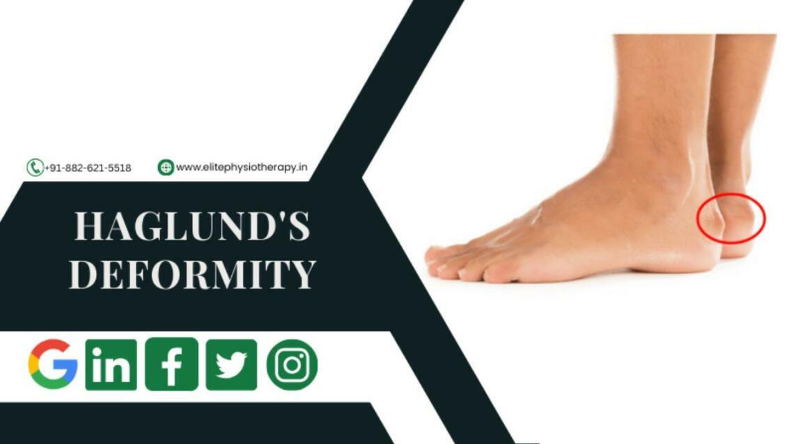 Haglund’s Deformity