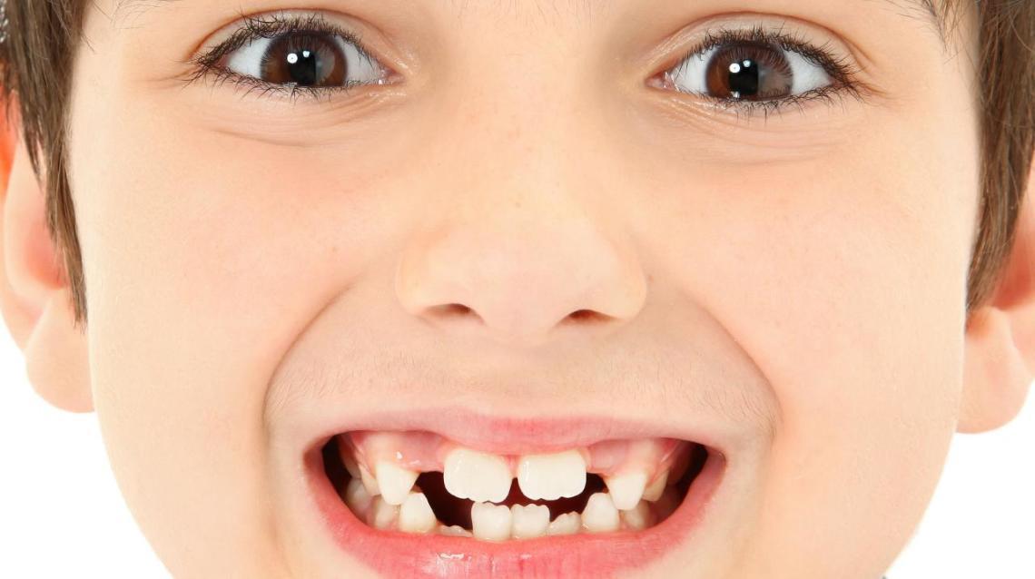 How Many Milk Teeth Does A Child Have 