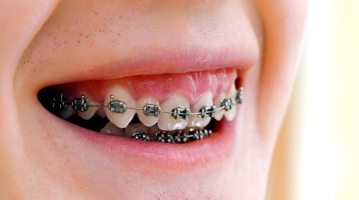 All About Braces