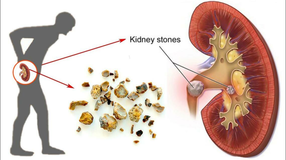 Kidney Stone - Symptoms - Best Urologist Mumbai Dr. Dilip Raja