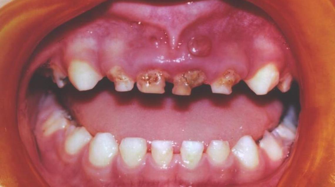 Primary Teeth / Milk Teeth