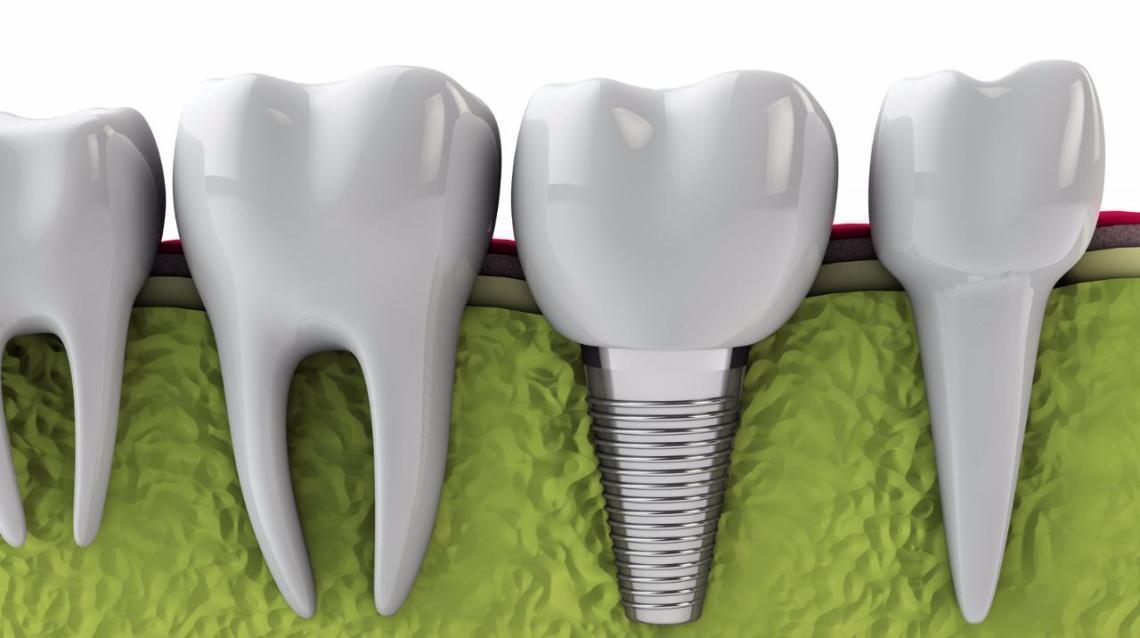 Let's Plant An Implant.