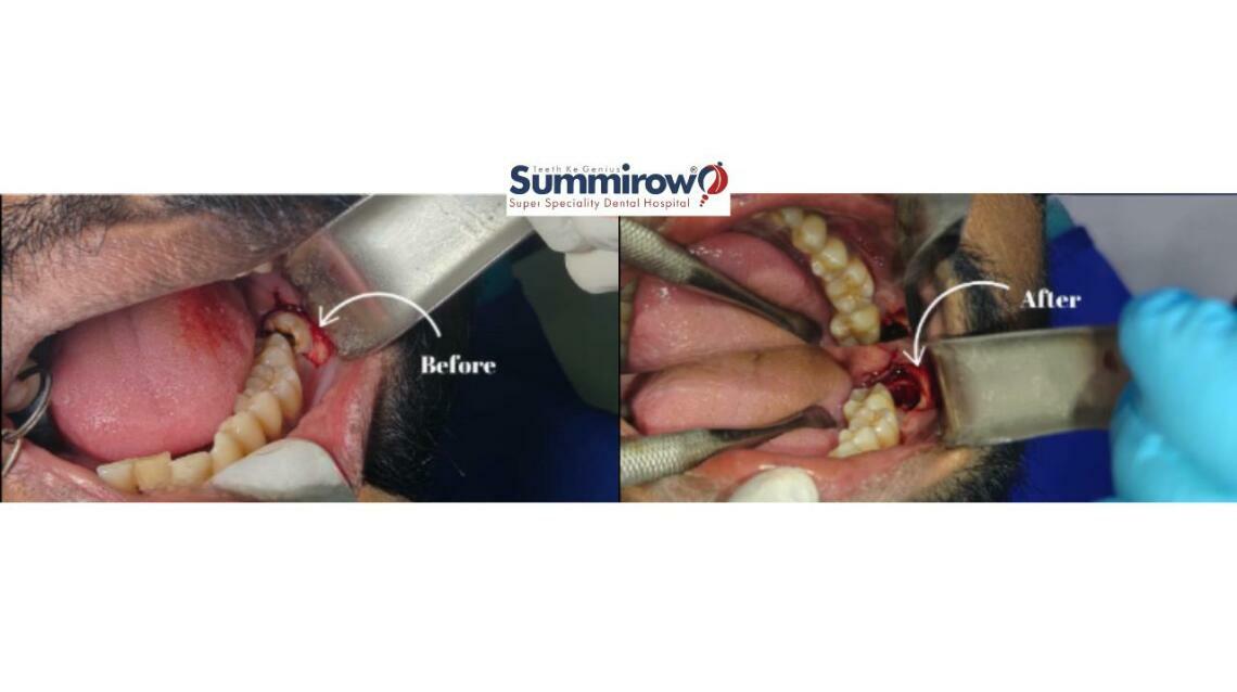 Surgical Extraction of a Decayed Lower Left Back Tooth: A Detailed Step ...