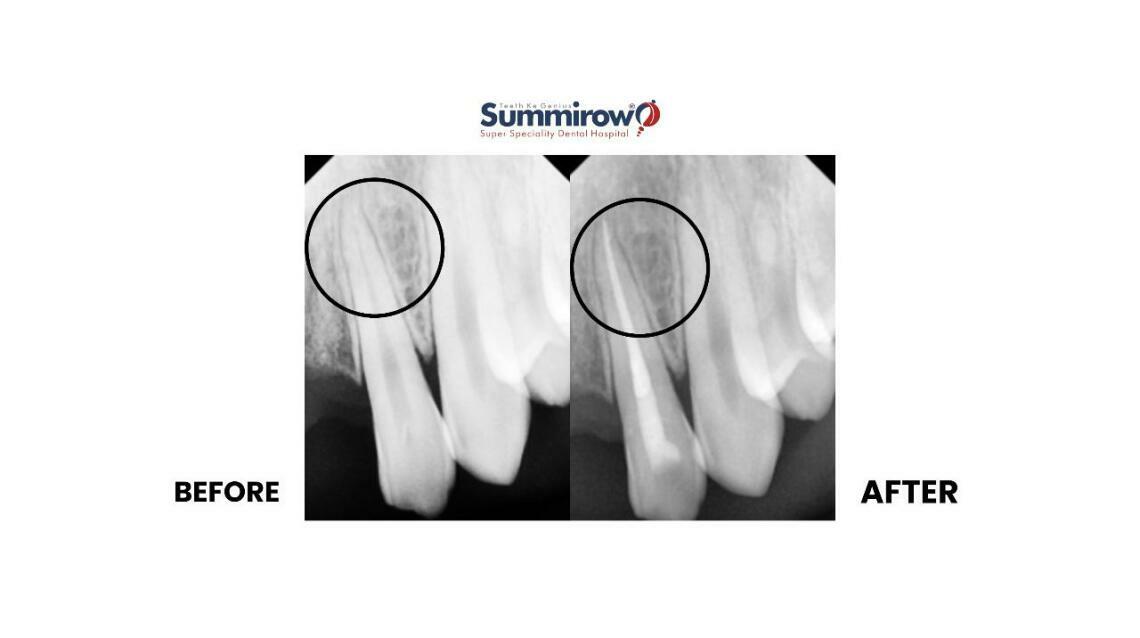 Restoring Smile With Single Sitting Rct and Crown Bridge in the Upper ...