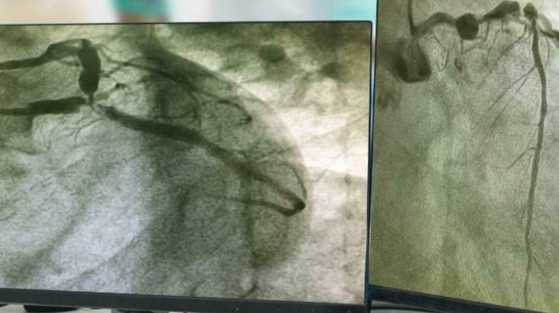 What Is Angiography and Is It a Risky Procedure?