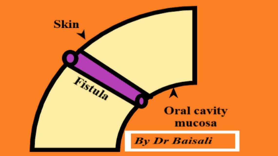 Are You Facing Continuous Leakage of Fluid From Skin?? (Orocutaneous ...