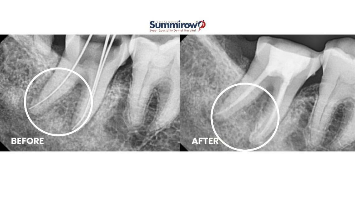 Root Canal Treatment in Tooth 47