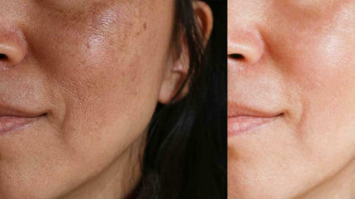Pdrn for Pdl: Healing Pigmented Dermal Lesions From Within