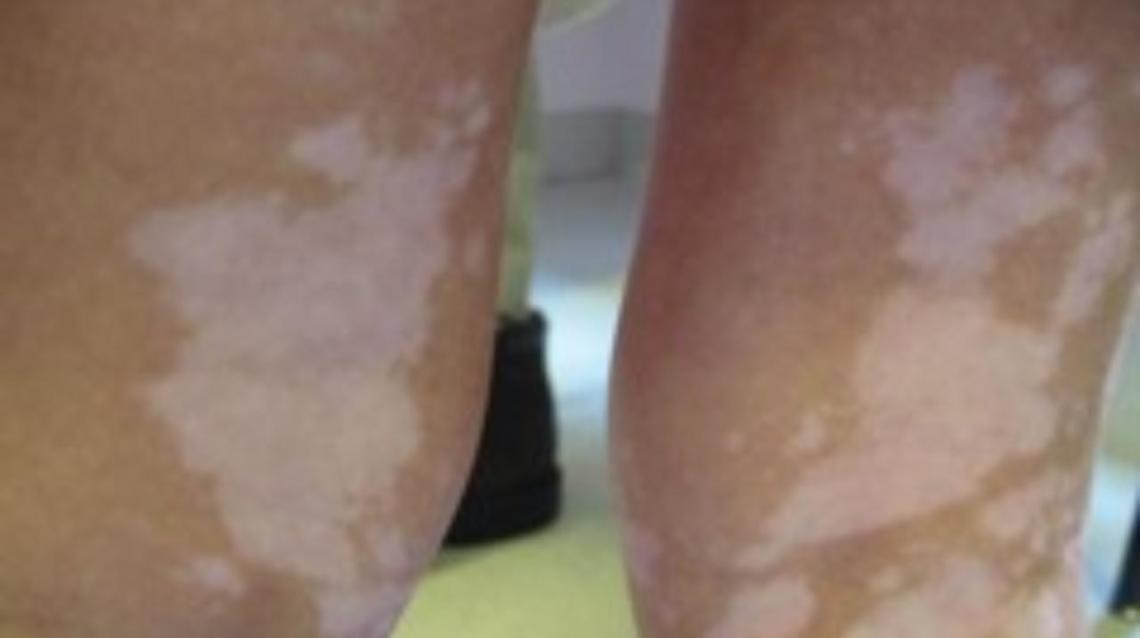 Leucoderma- Myths and Facts