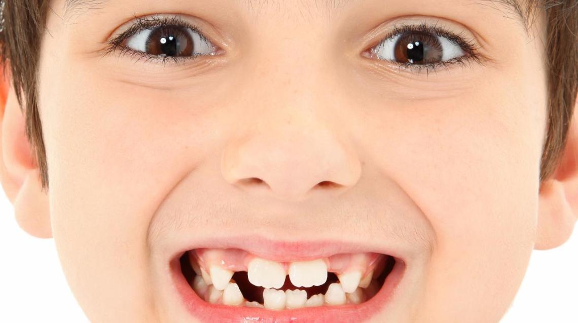 Genaralized Spacing Between Teeth