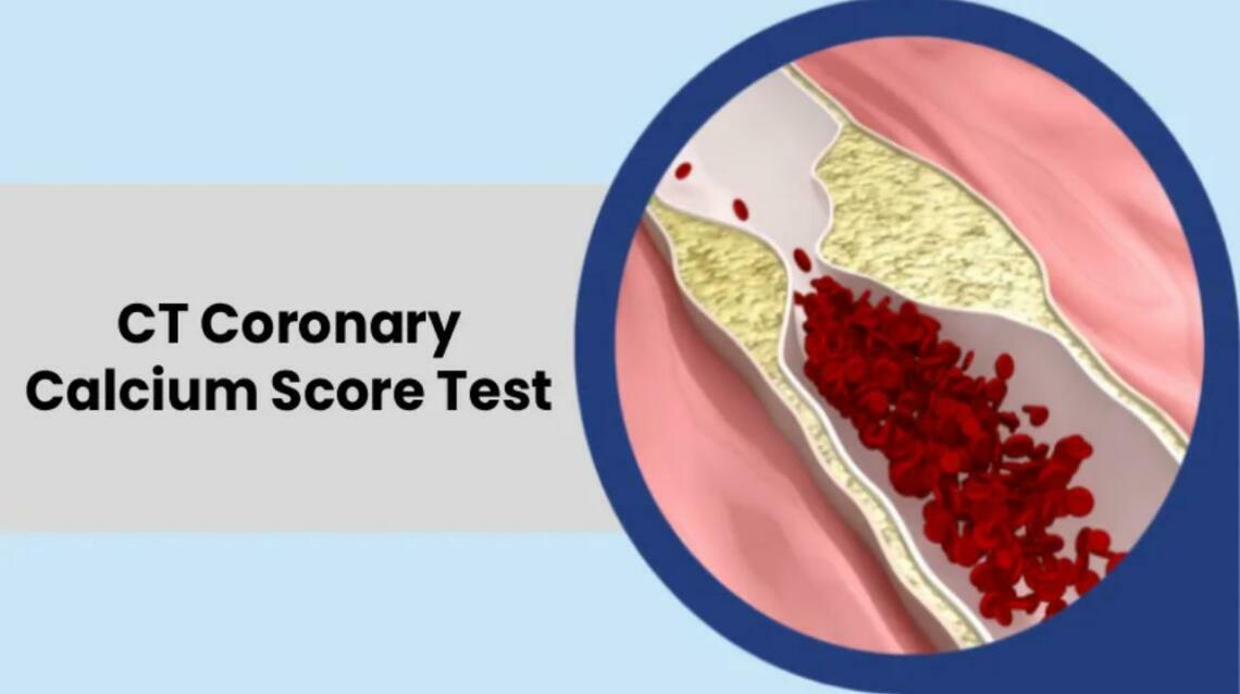 What Is a Ct Coronary Calcium Score Test? When Do You Need It?