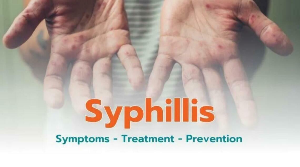 Syphilis: A Comprehensive Overview