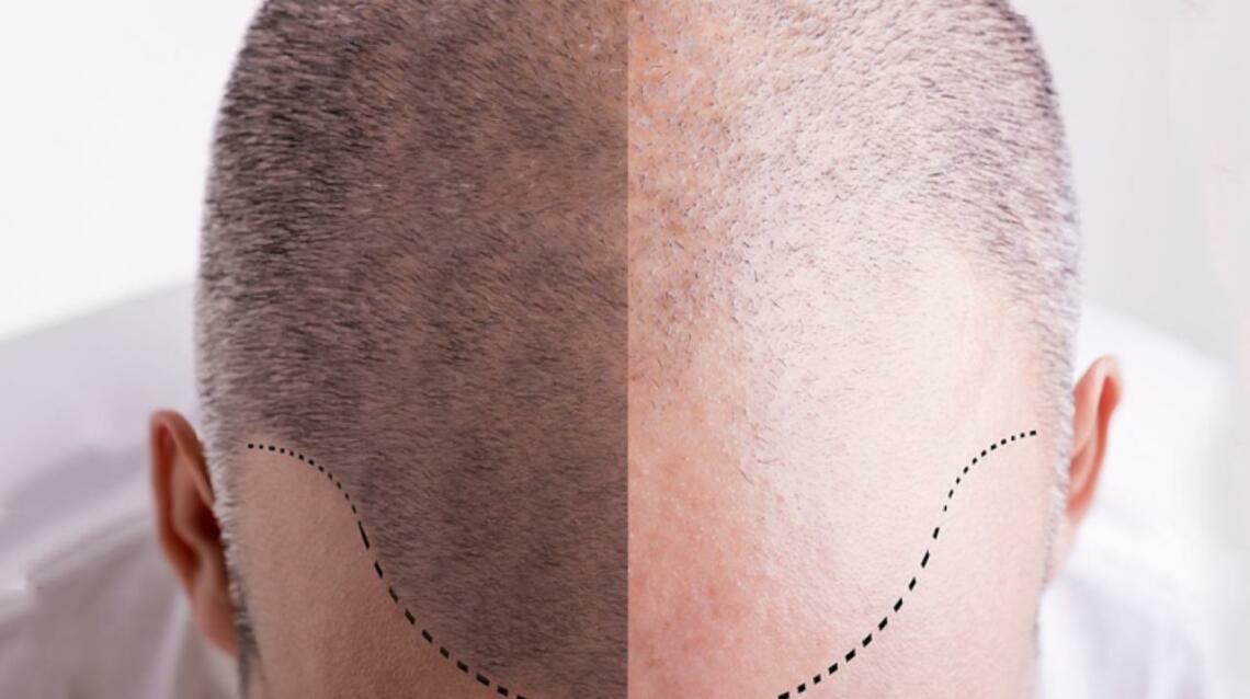 "The Art of Scalp Micropigmentation: Why Expertise Matters"