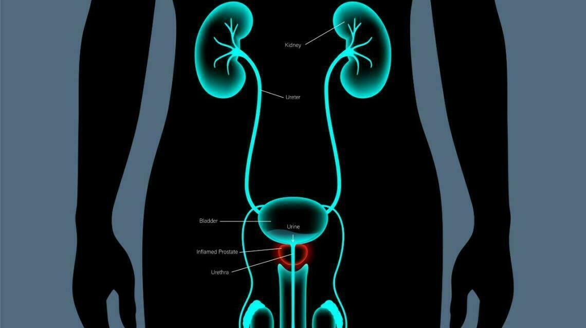 Understanding Vesicoureteric Reflux in Adults