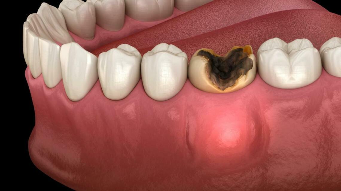 Swellings Related to the Teeth #Dental Abscess.