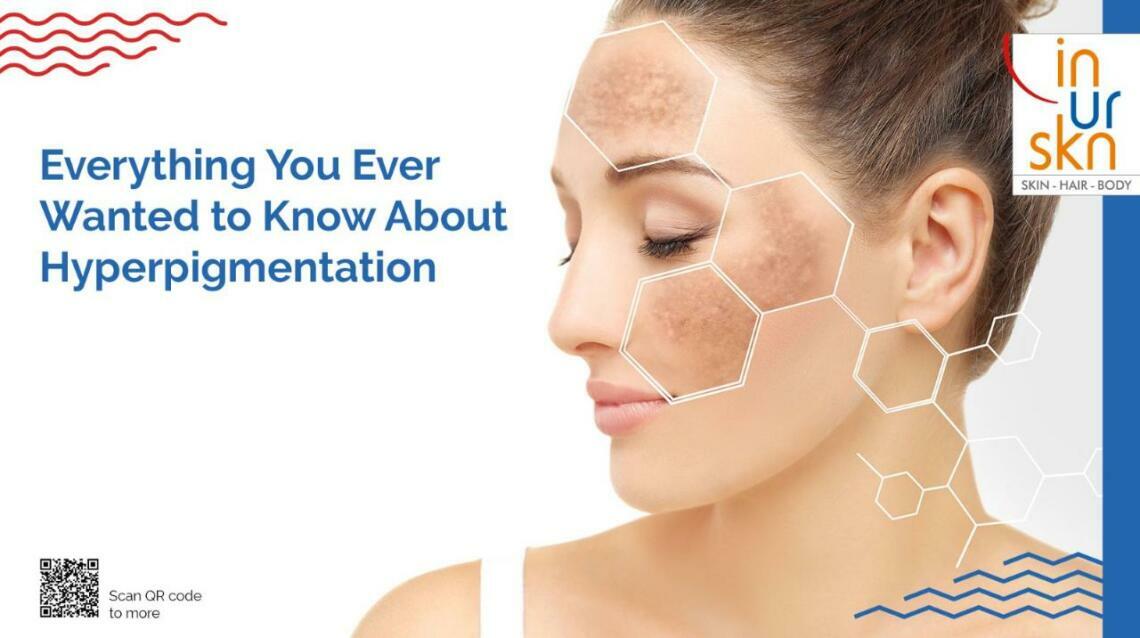 Everything You Ever Wanted to Know About Hyperpigmentation.