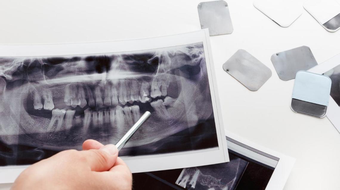 Surgical Removal of Wisdom Tooth (Disimpaction)