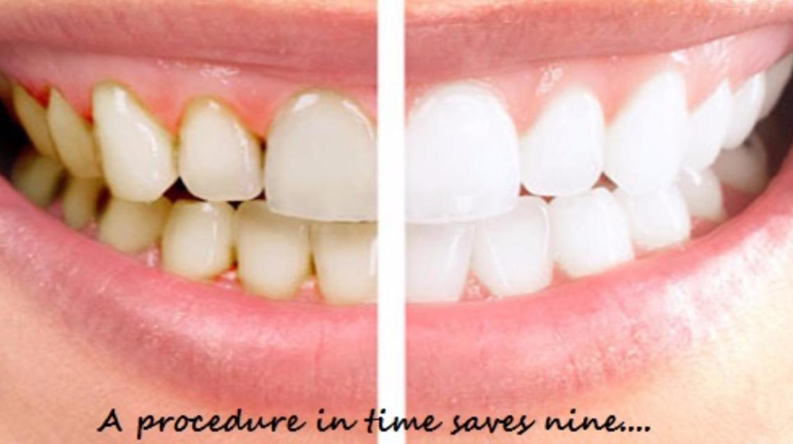 Untold Benefits of Scaling - a Procedure in Time Saves Nine