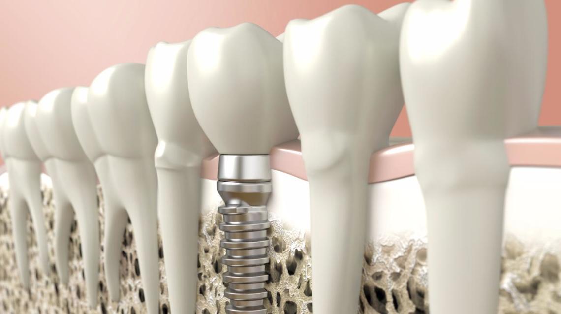 Eye Opening Facts About Dental Implants