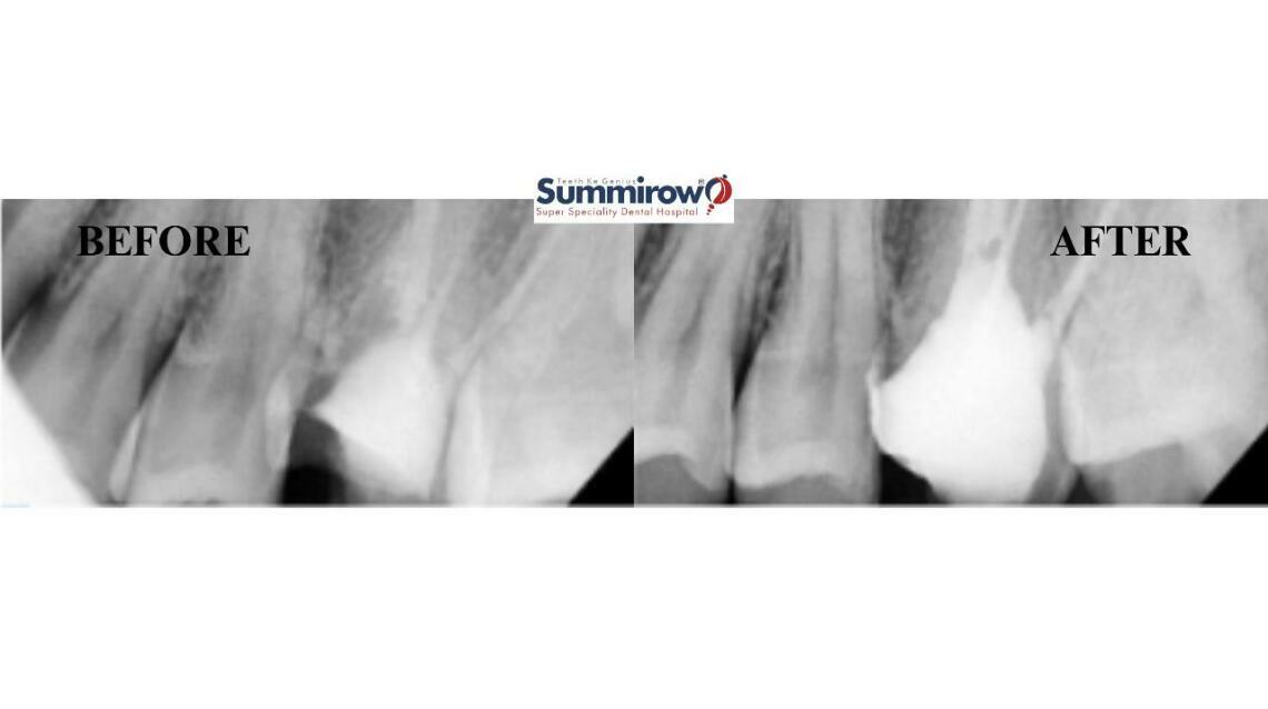 Understanding Rct Retreat and Crown Placement for a Previously Treated ...