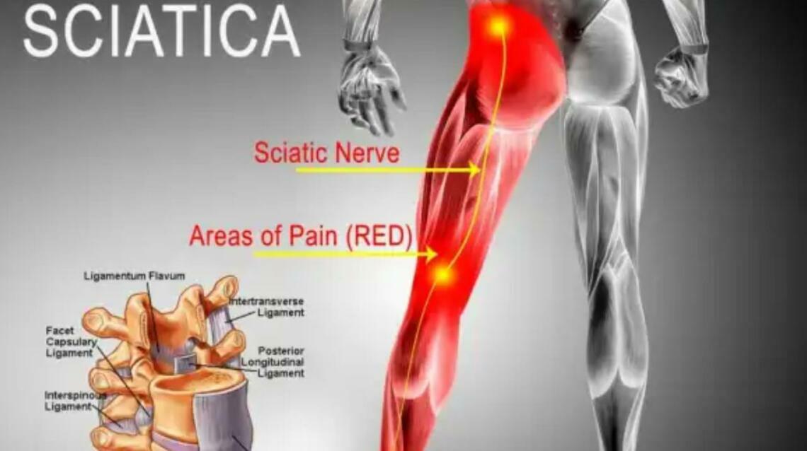 How Acupuncture Helps in Treating Lower Back Pain With Sciatica?