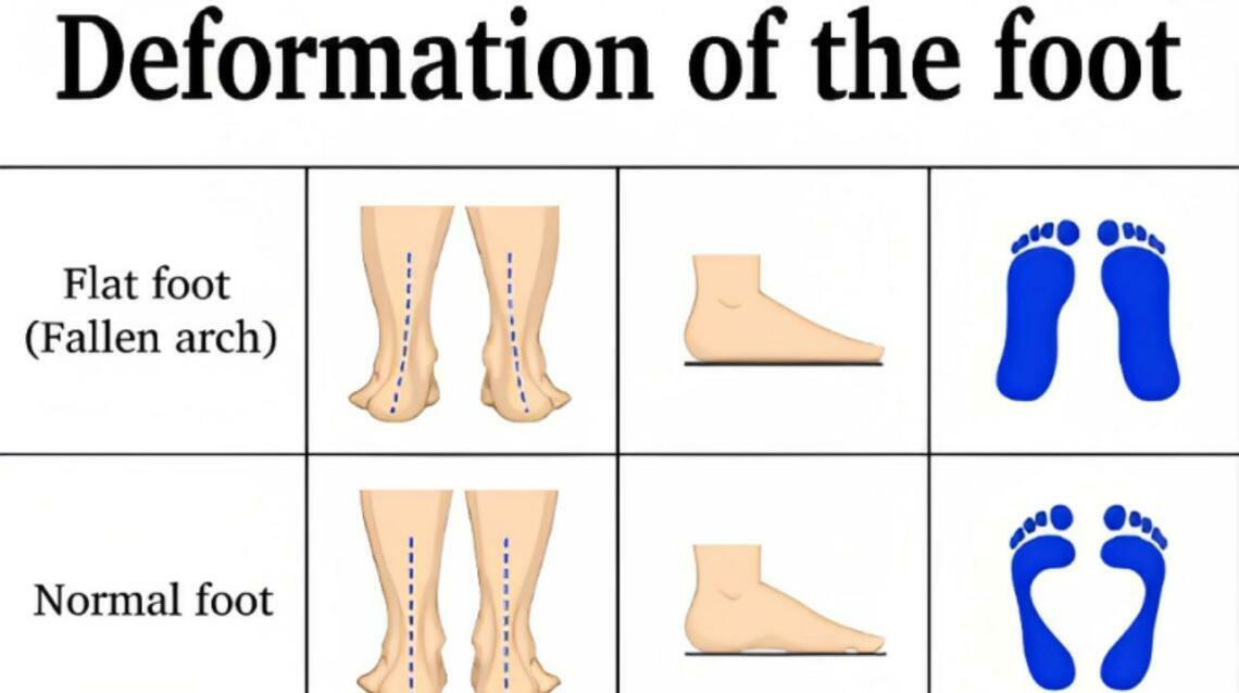 Take Care of Your Flat Foot as Soon as Possible