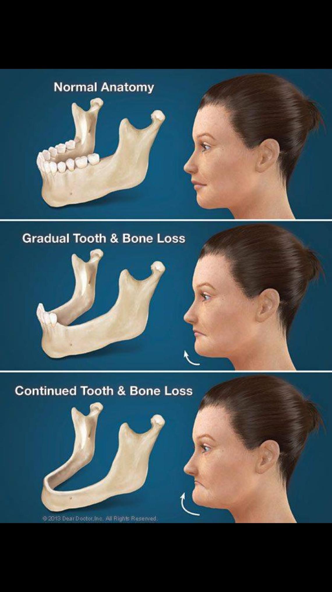 What Happens If A Lost Tooth is Not Replaced?
