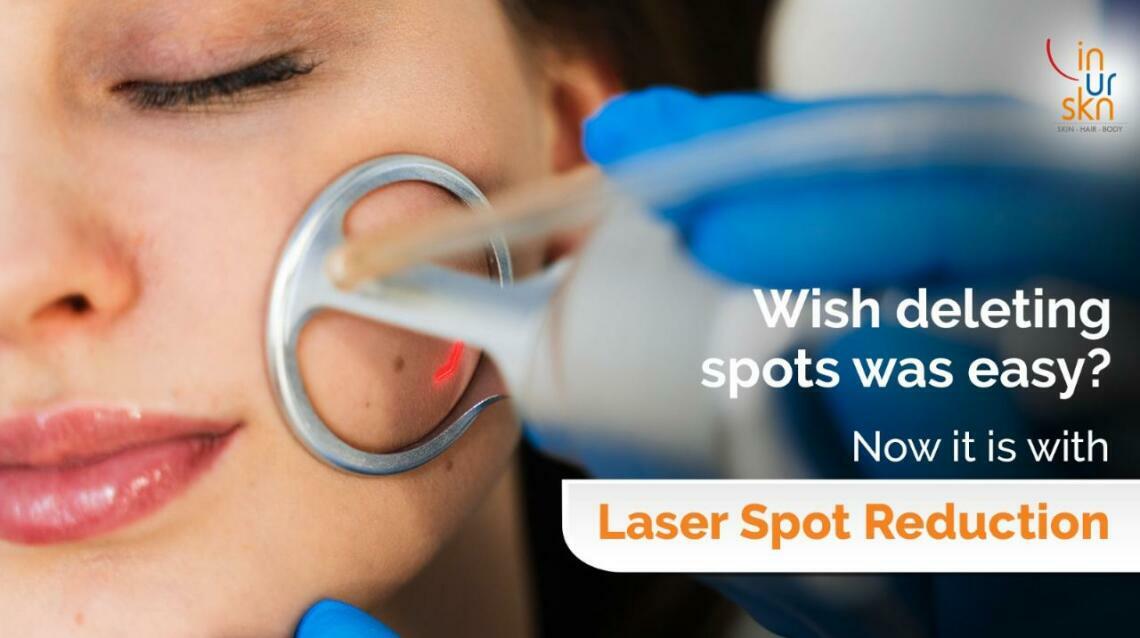 The Ultimate Spot-Fix: Lasers, Science & a Whole Lot of Glow!