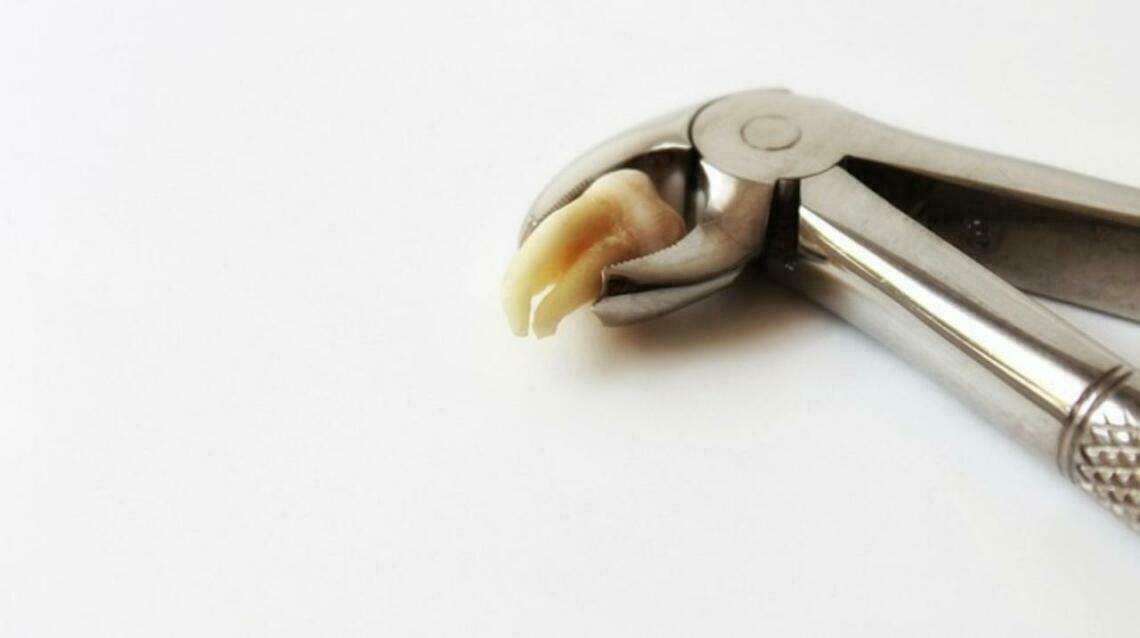 What Happens After Tooth Extraction?