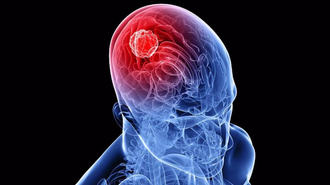 Brain Tumor - Causes, Symptoms and Treatment