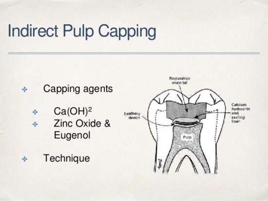 Indirect Pulp Capping In Primary Teeth - TeethWalls