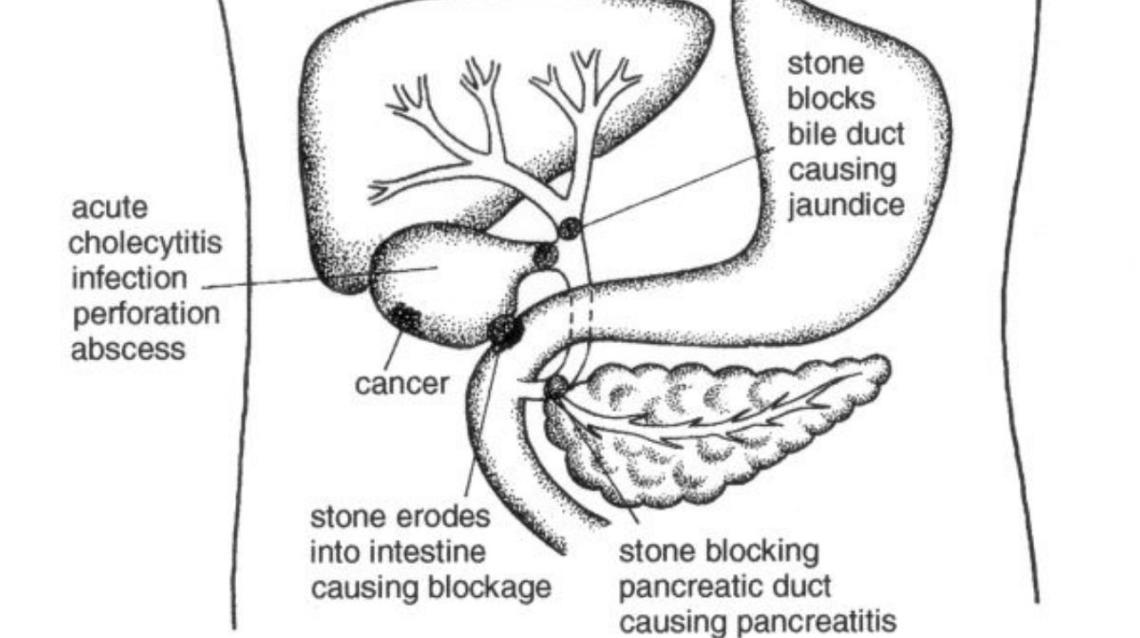Gallbladder Stone Complications