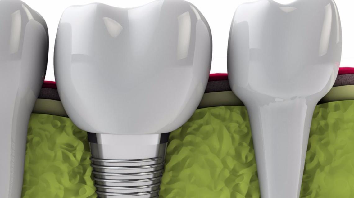 Extraction of Impacted Maxillary Canine With Simultaneous Implant Placement