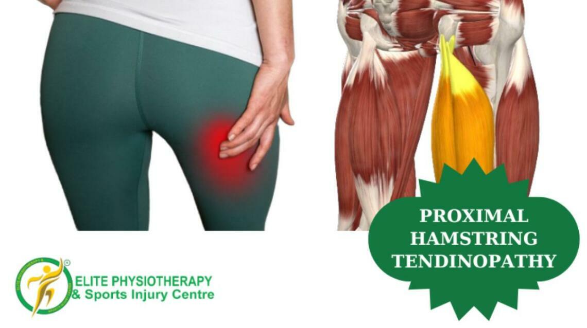 What Is Proximal Hamstring Tendinopathy?