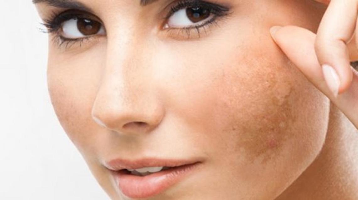 Blemishes On Skin
