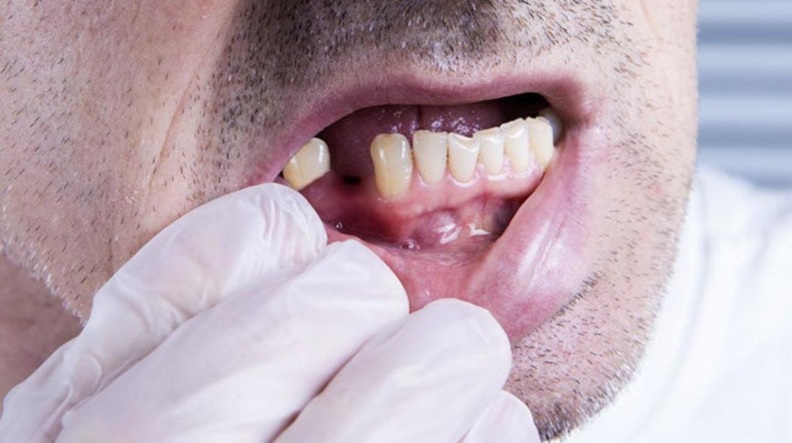 Will Your Belly Fat Cause Tooth Loss?