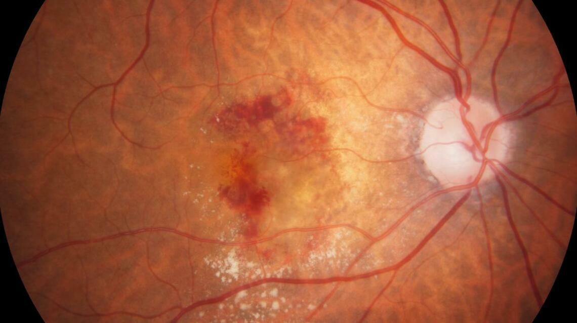 7 Signs You Should Know About Retinal Disorder