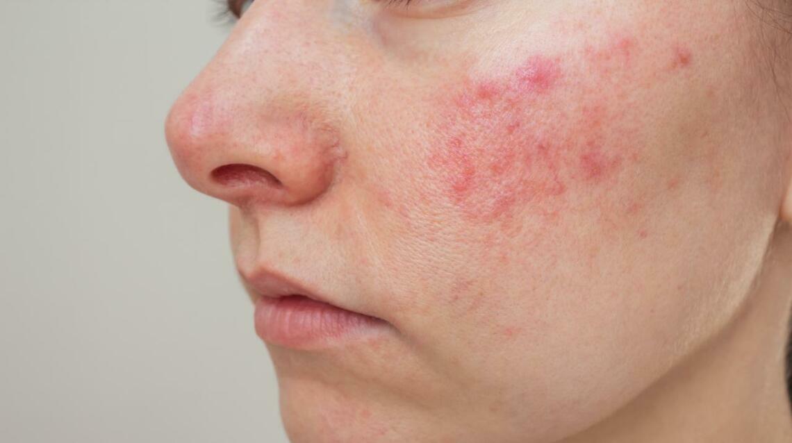 Rosacea : Understanding Triggers, Treatments, and Daily Management