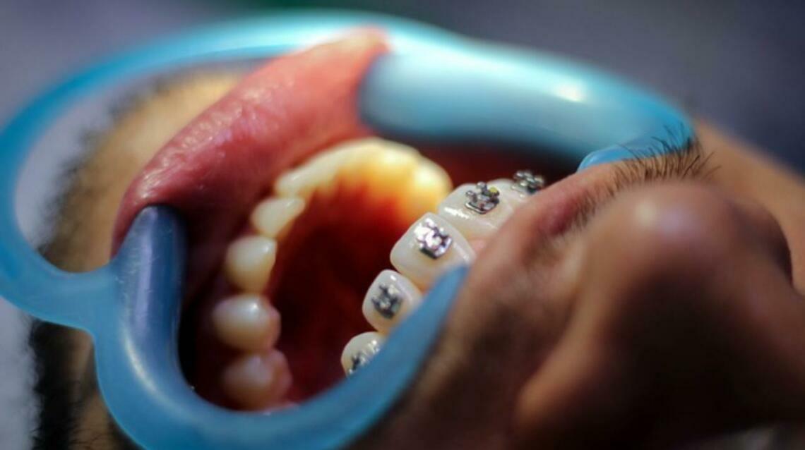 How to Keep Your Smile Sparkling With Braces?