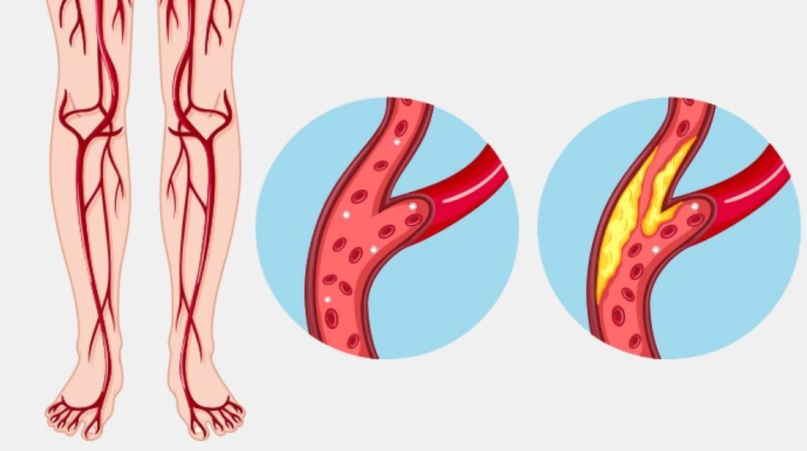 Peripheral Arterial Occlusive Disease (Paod): Cause of a "Leg Attack"